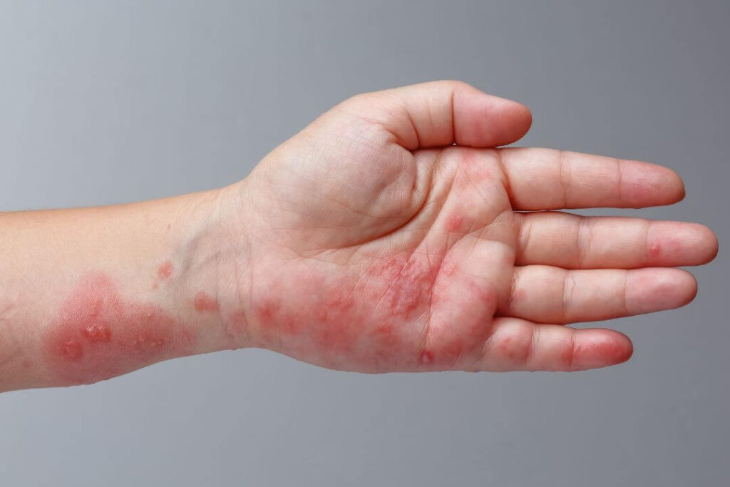 7 boli de piele transmisibile și cum eviți infectarea cu acestea ️ ...