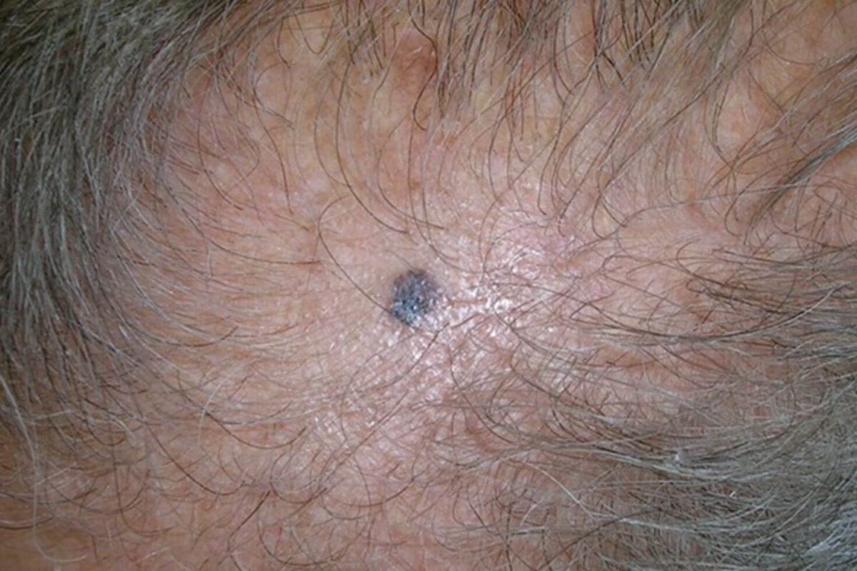 Carcinom bazocelular: cel mai frecvent tip de cancer de piele (foto) ️ ...