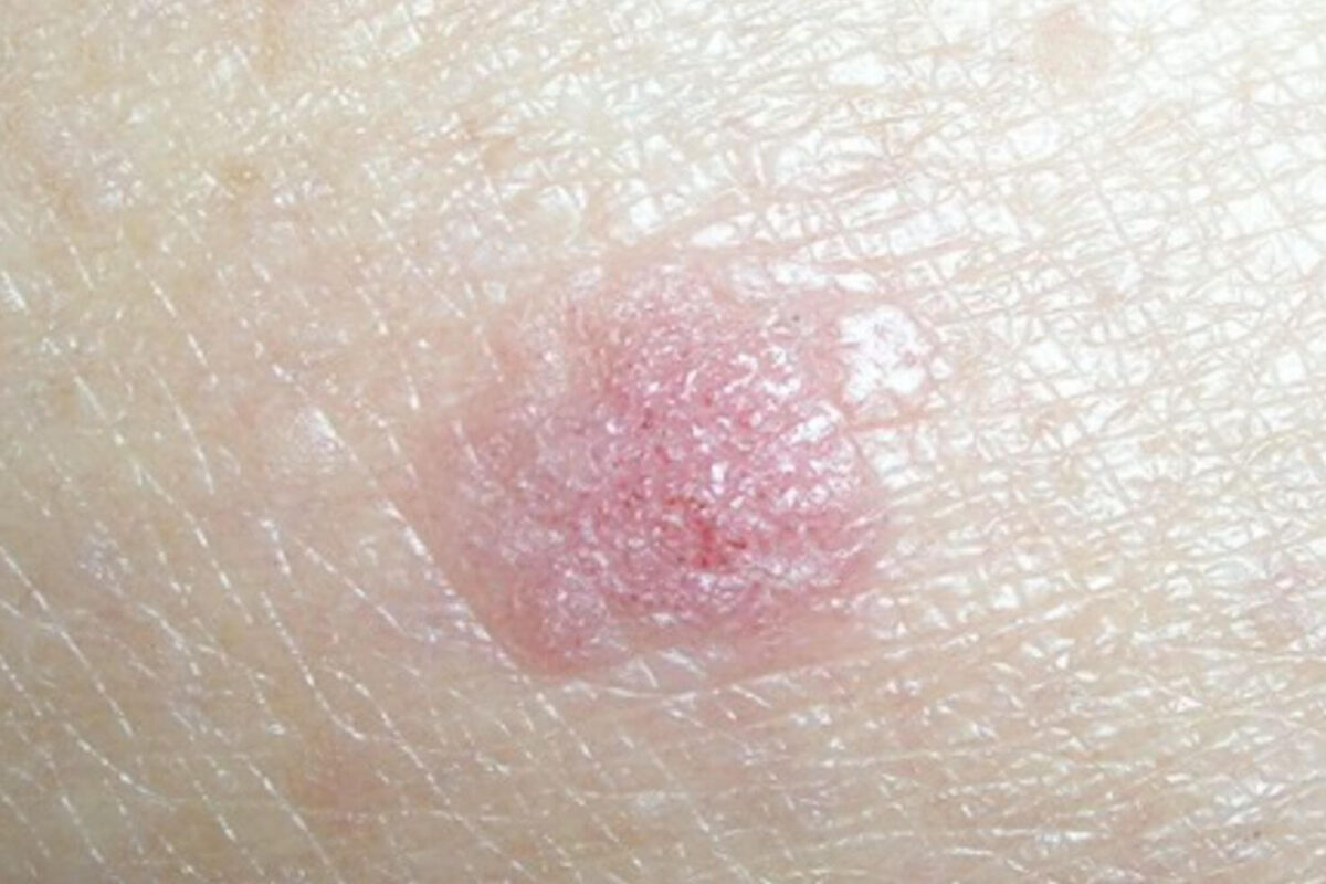 Carcinom spinocelular: cum arată și cum îl poți preveni ️ Clinica Medlink