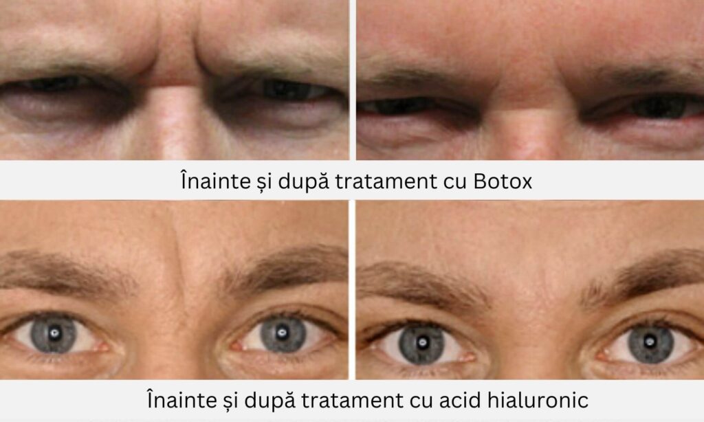 Riduri între sprâncene - cele mai noi trucuri pentru a scăpa de ele ️ ...
